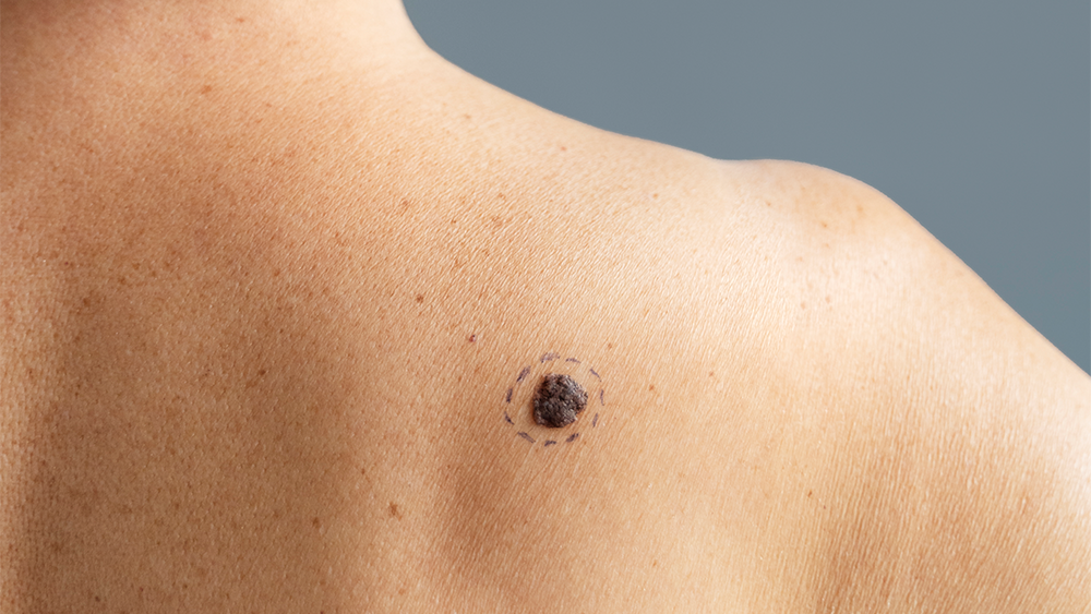 Biopsi Kulit: Langkah Penting dalam Diagnosis yang Akurat