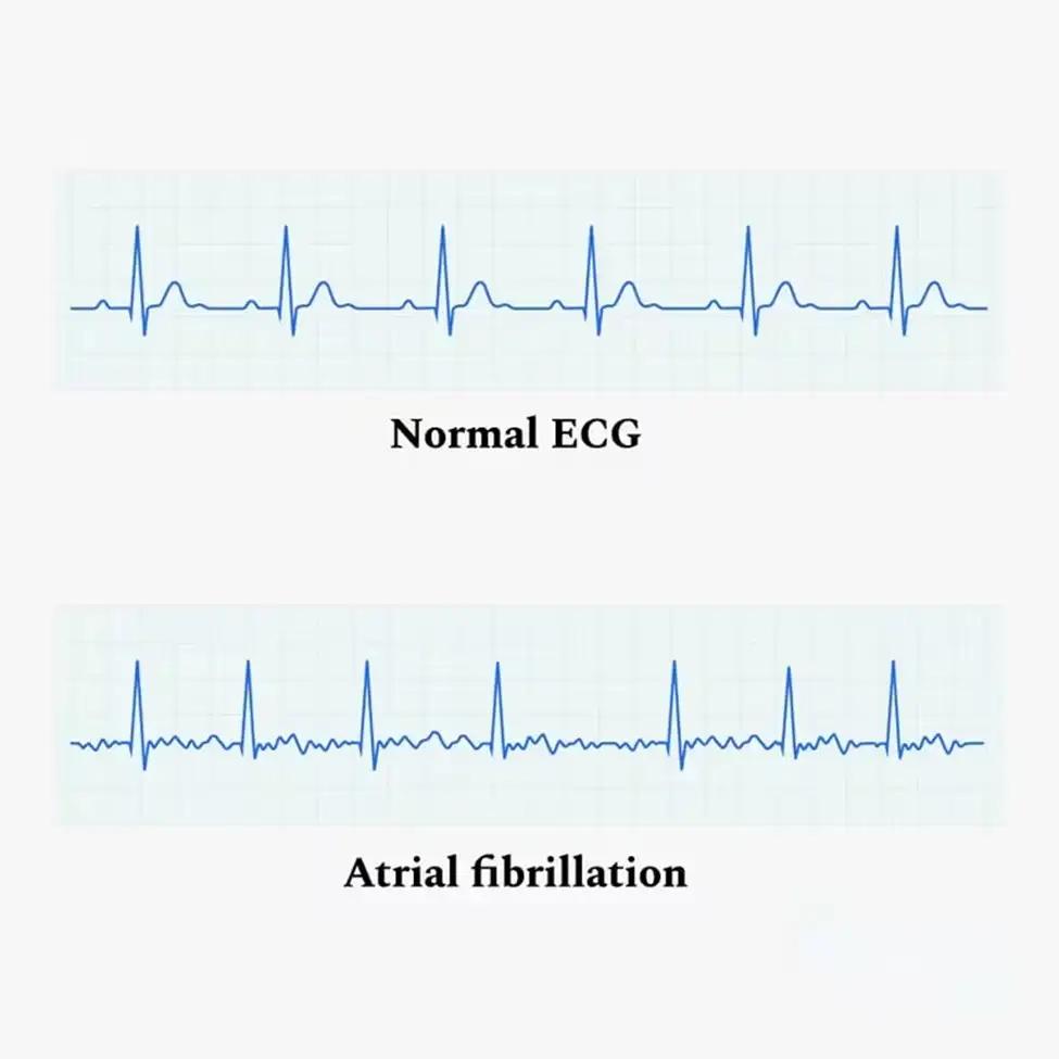 Atrial fibrilasi adalah gangguan irama jantung tidak beraturan. Cek ...