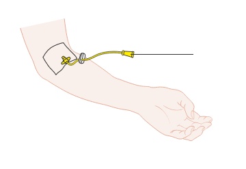 10 Alat Kemoterapi: Chemoport, Kanula, hingga Portacath - Tzu Chi Hospital