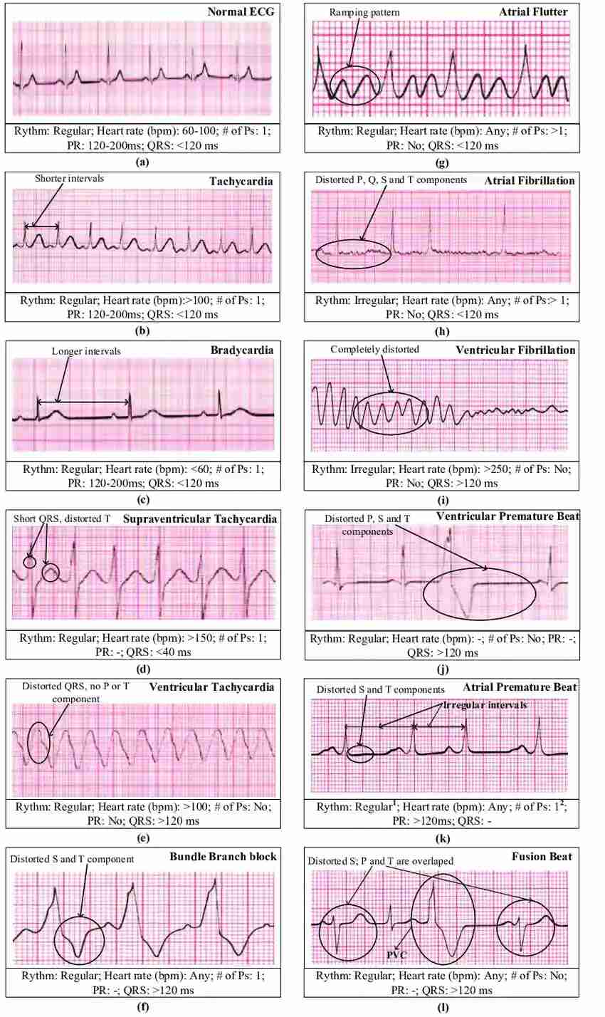 Aritmia Jantung: Gejala, Diagnosis, Penyebab, & Pencegahannya - Tzu Chi ...