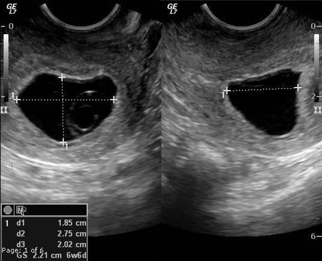 9 Ciri-Ciri Janin Tidak Berkembang di Trimester 1 & Penyebabnya - Tzu ...