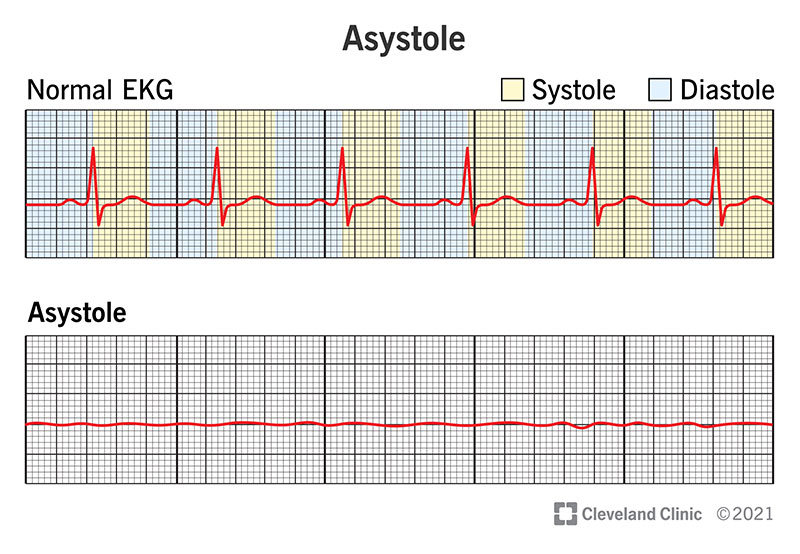EKG Asistol (Garis Datar) – Penyebab, Ciri & Langkah yang Dilakukan ...