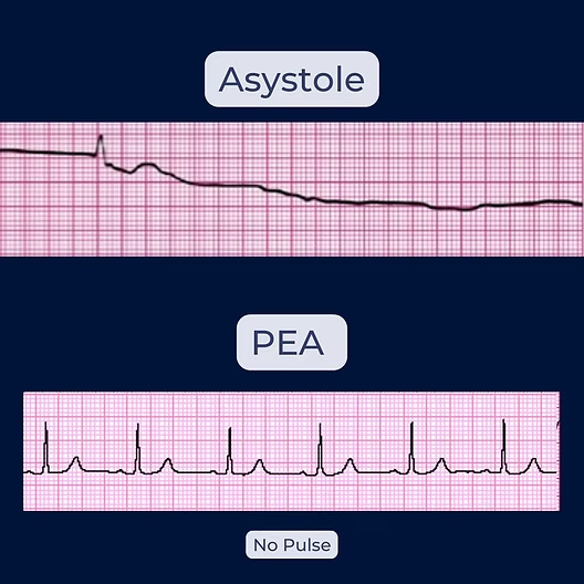 EKG Asistol (Garis Datar) – Penyebab, Ciri & Langkah yang Dilakukan ...