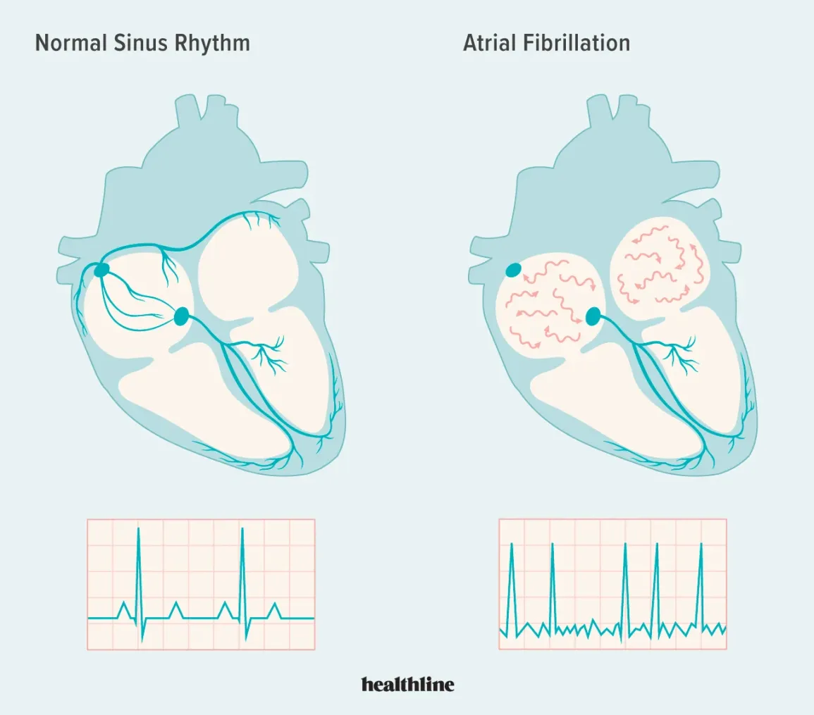 Sinus Aritmia: Penyebab, Gejala, Diagnosis & Penanganan - Tzu Chi Hospital