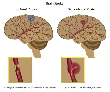Stroke – Ciri, Penyebab, dan Cara Mencegahnya Sebelum Terlambat - Tzu ...